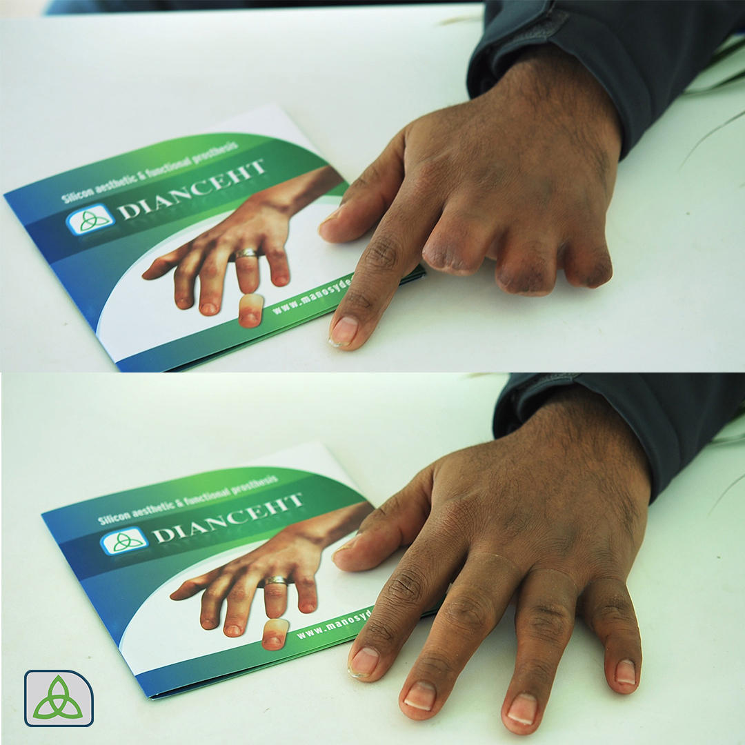 Finger - Dianceht