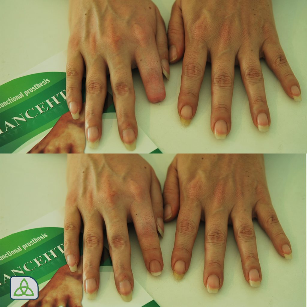 Prosthetic finger