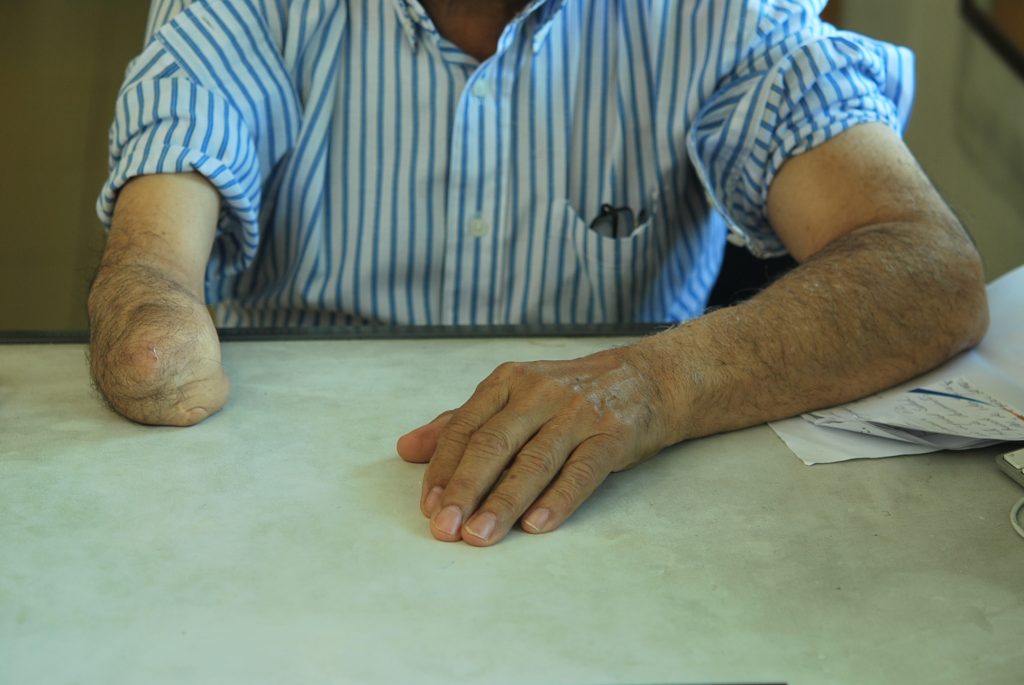 Prosthetic arm