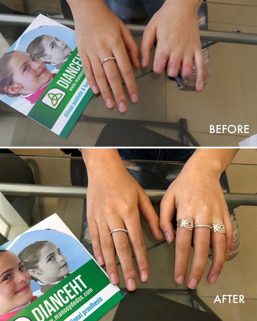 Prosthetic finger