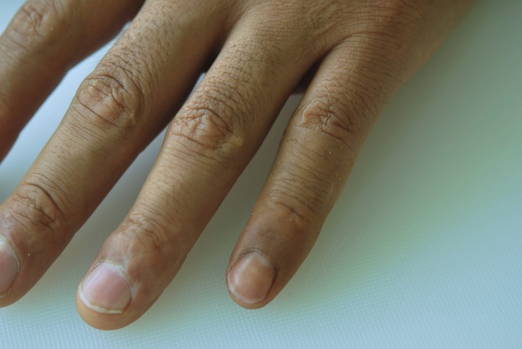 Prosthetic finger
