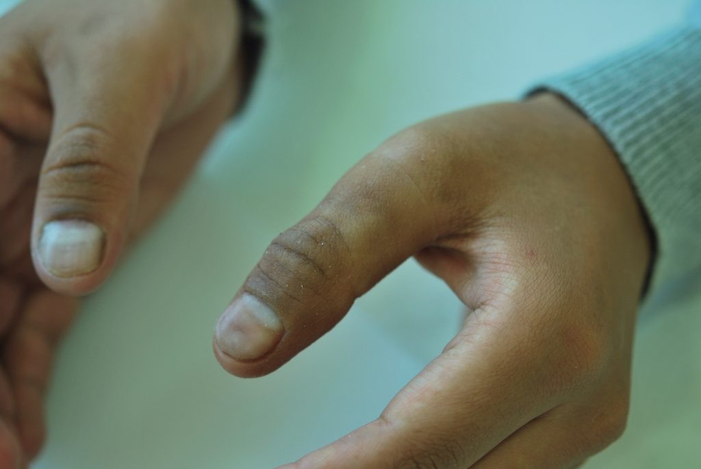 Prosthetic finger